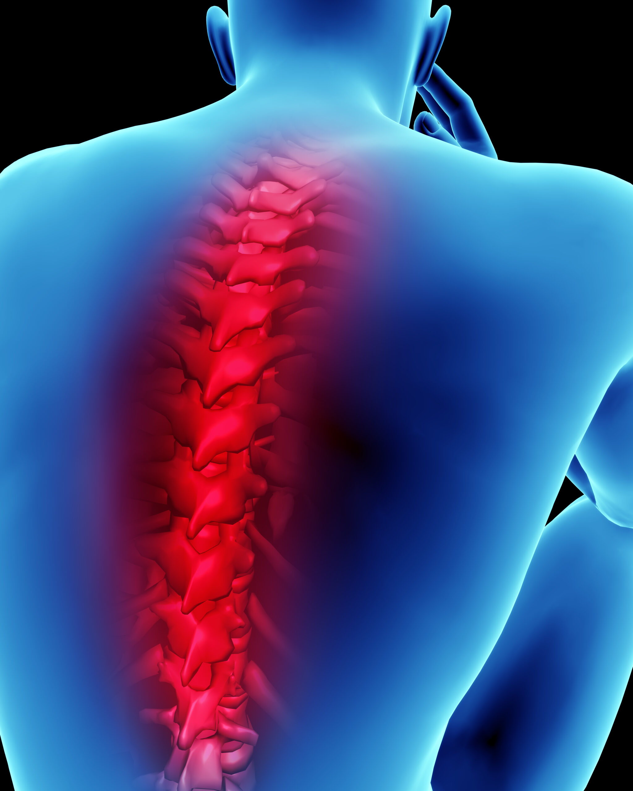 Compression Fracture Back Injuries | El Dabe Ritter Trial Lawyers